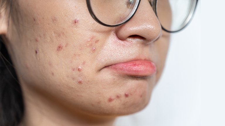 Ketahui Cara Tepat Menggunakan Serum Penghilang Bekas Jerawat