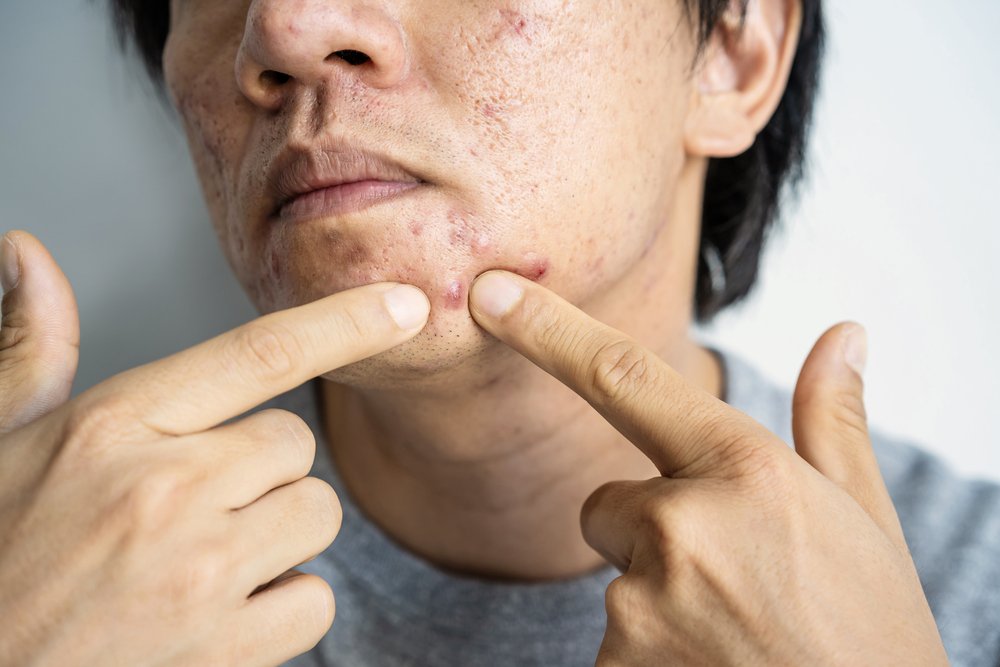 Apa Itu Jerawat Pustula dan Apa Bedanya dengan Papula?